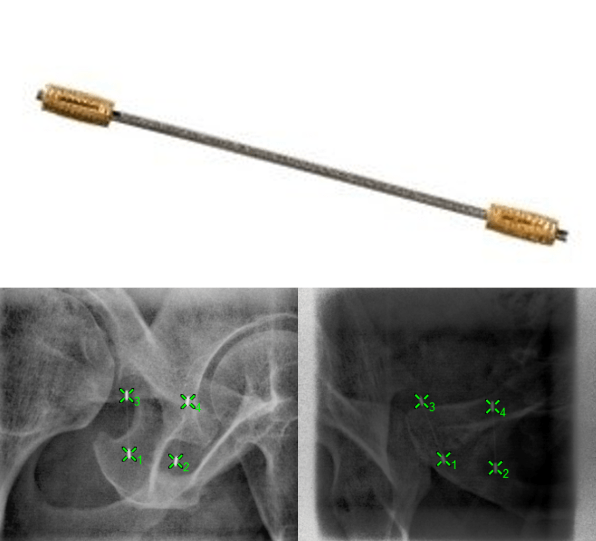 Fiducial and SpaceOAR procedure - Thomas Kole, MD, PhD